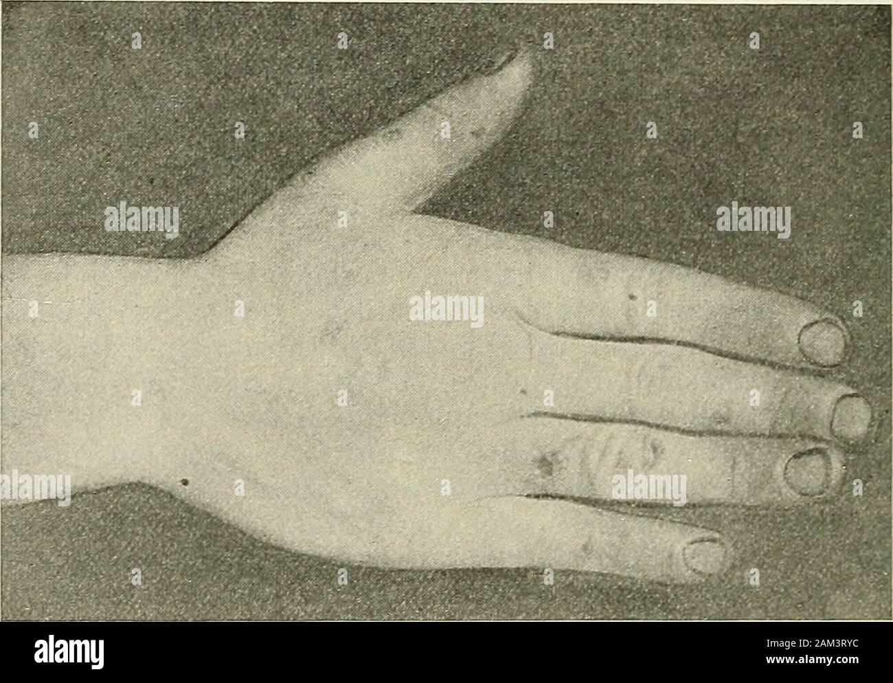 Buboes hi-res stock photography and images - Alamy