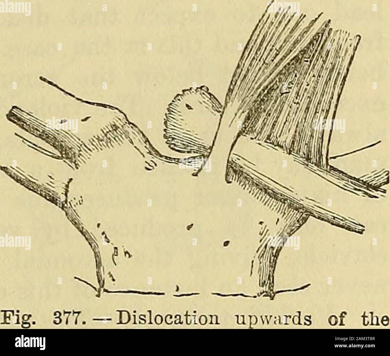 A system of surgery . ion. To depress the shaftof the clavicle, a ...