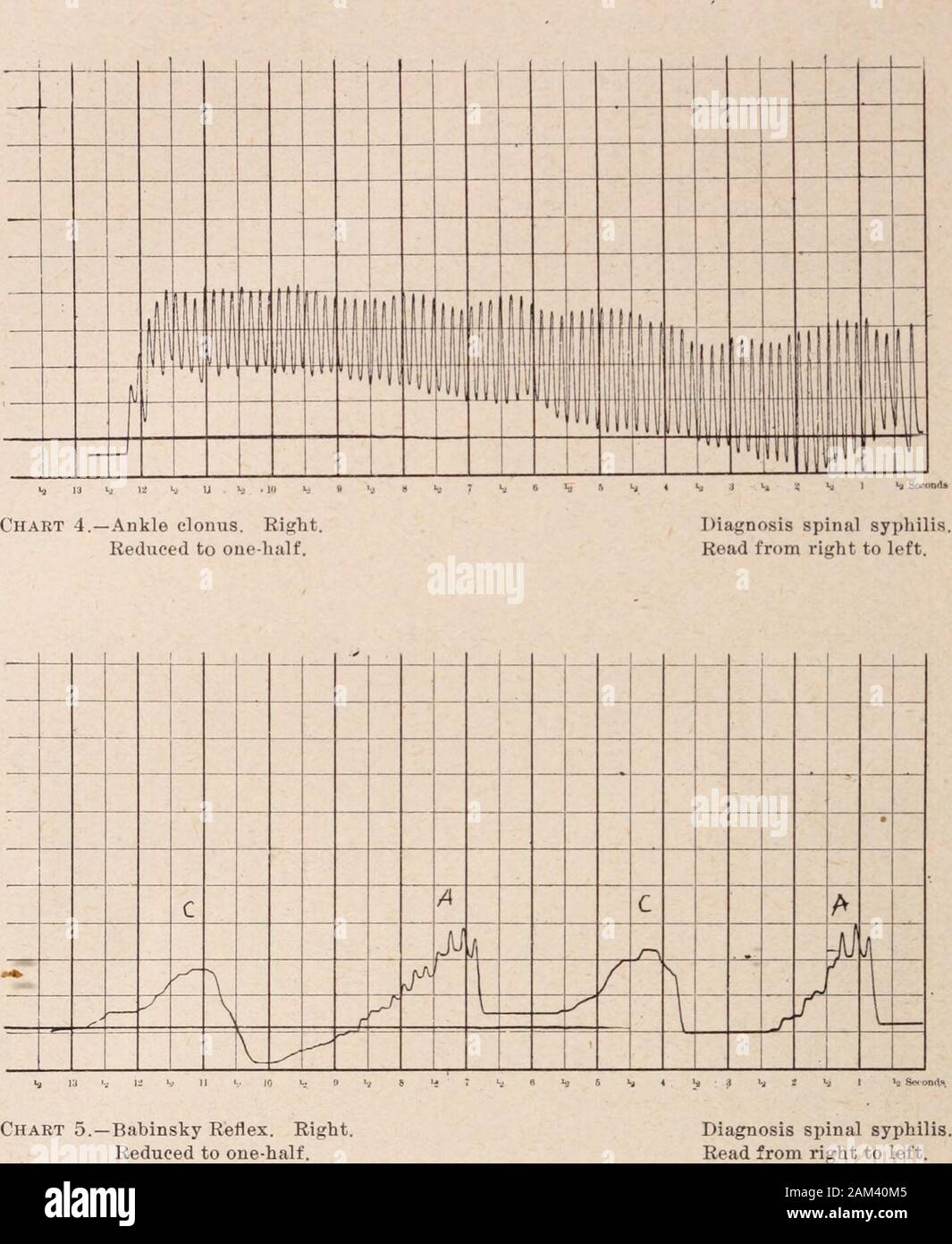Interstate medical journal . Chart 1.—Lighter. Ankle clonus. Right ...