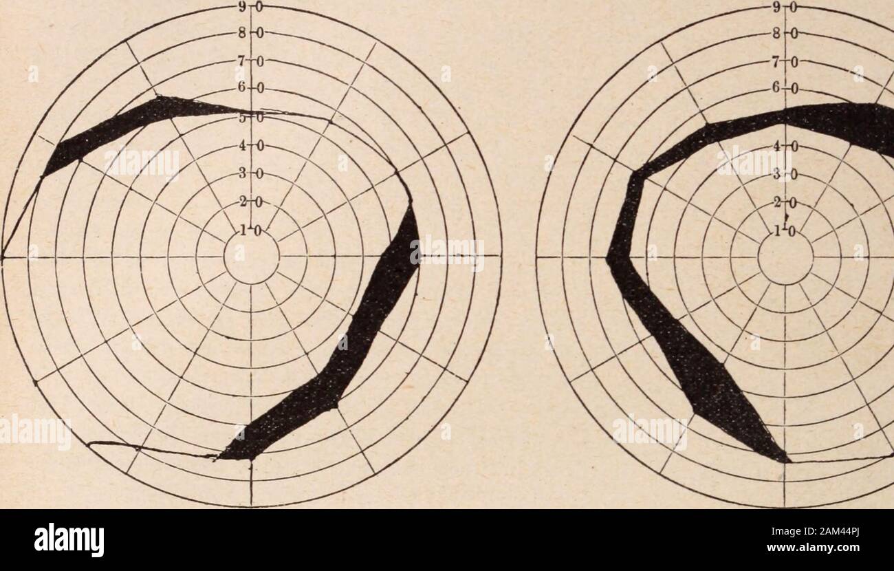 Scotoma hi-res stock photography and images - Alamy