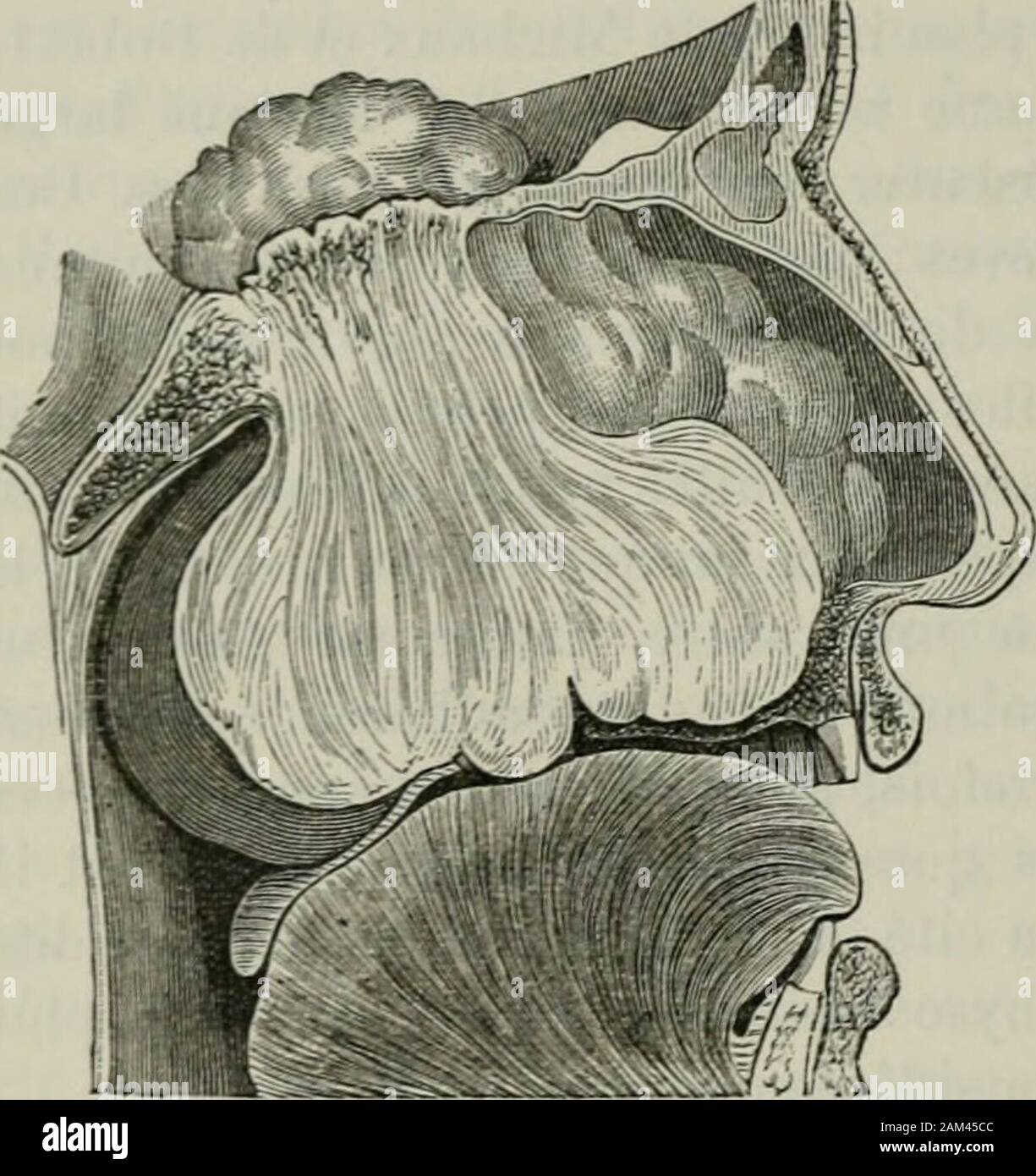Chirurgie des sinus hi-res stock photography and images - Alamy