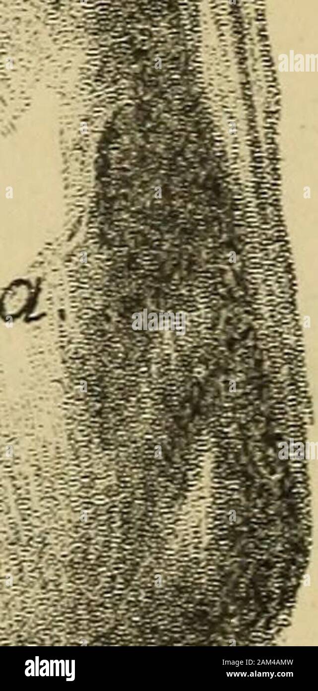 Pronounced Coronal Ridge