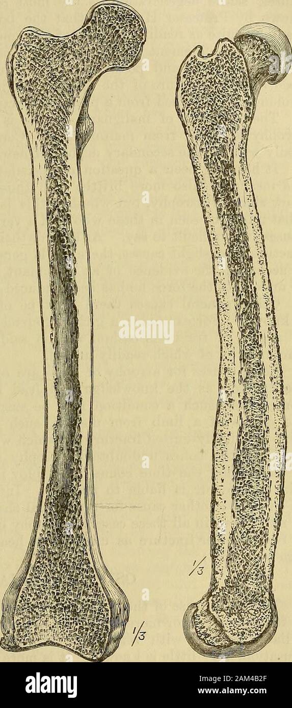 A system of surgery . Fig. 339.—Horizontal Section of a Skull, showing ...