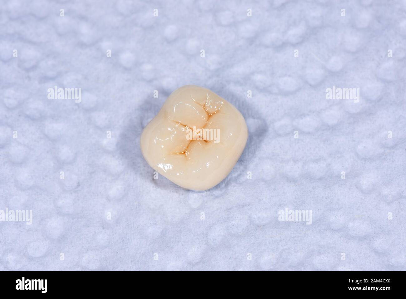 Ceramic-metal crown of human tooth molar. Macro closeup. Dental ...