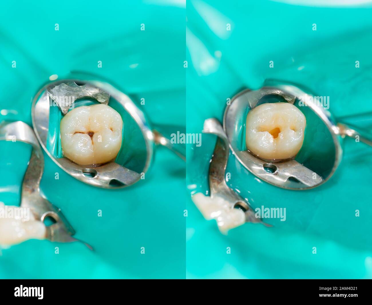 two chewing side teeth of the upper jaw after treatment of caries ...