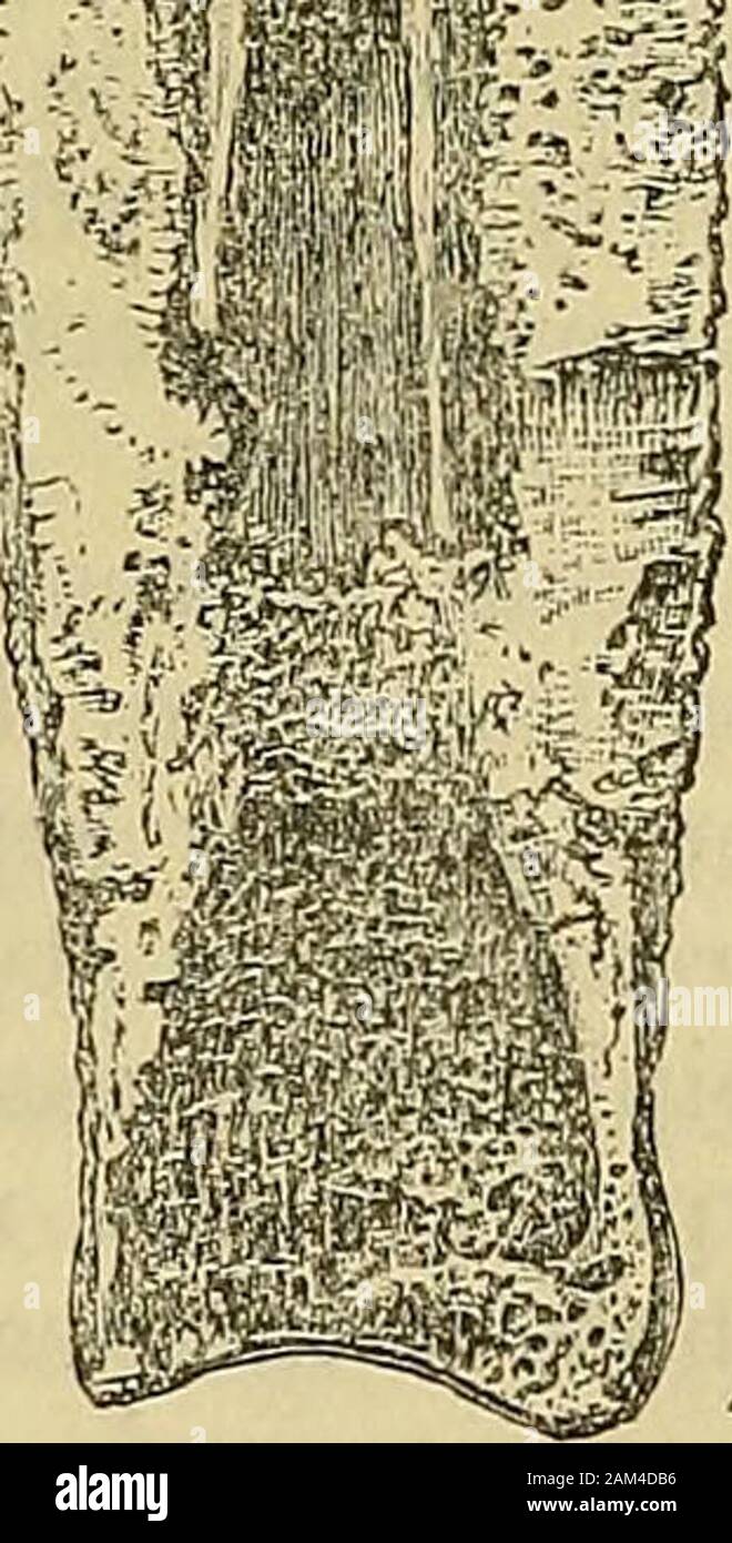 A system of surgery . the denser boneinto cancellous. (See page 873 ...