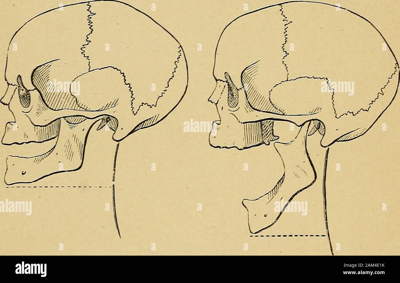 On stertor, apoplexy, and the management of the apoplectic state ...
