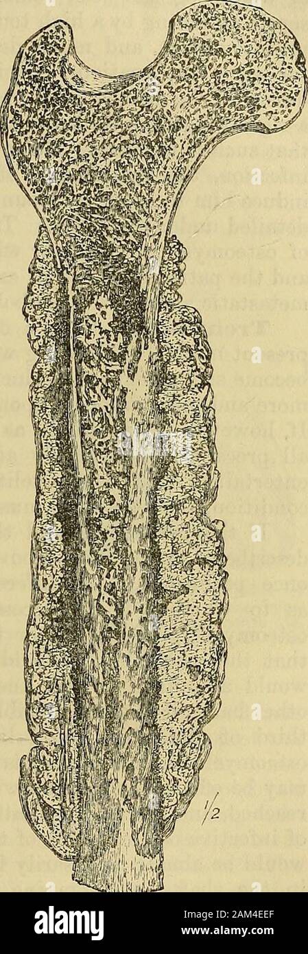 Pyaemia High Resolution Stock Photography and Images - Alamy