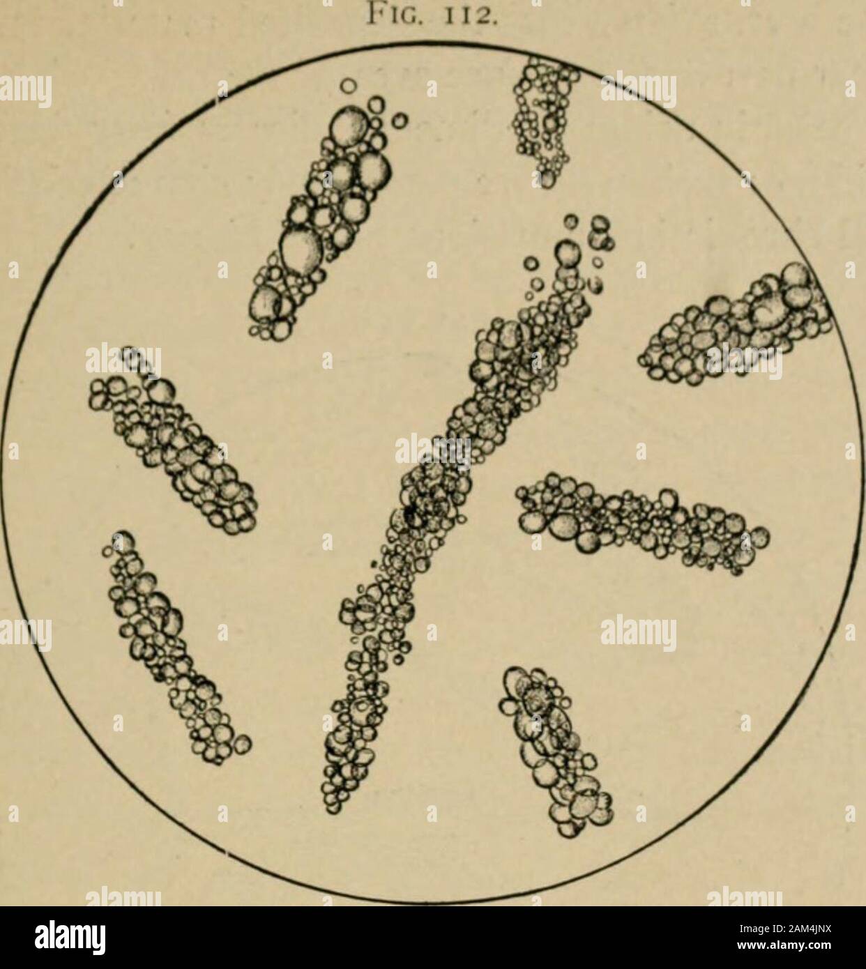 Fatty Casts In Urine
