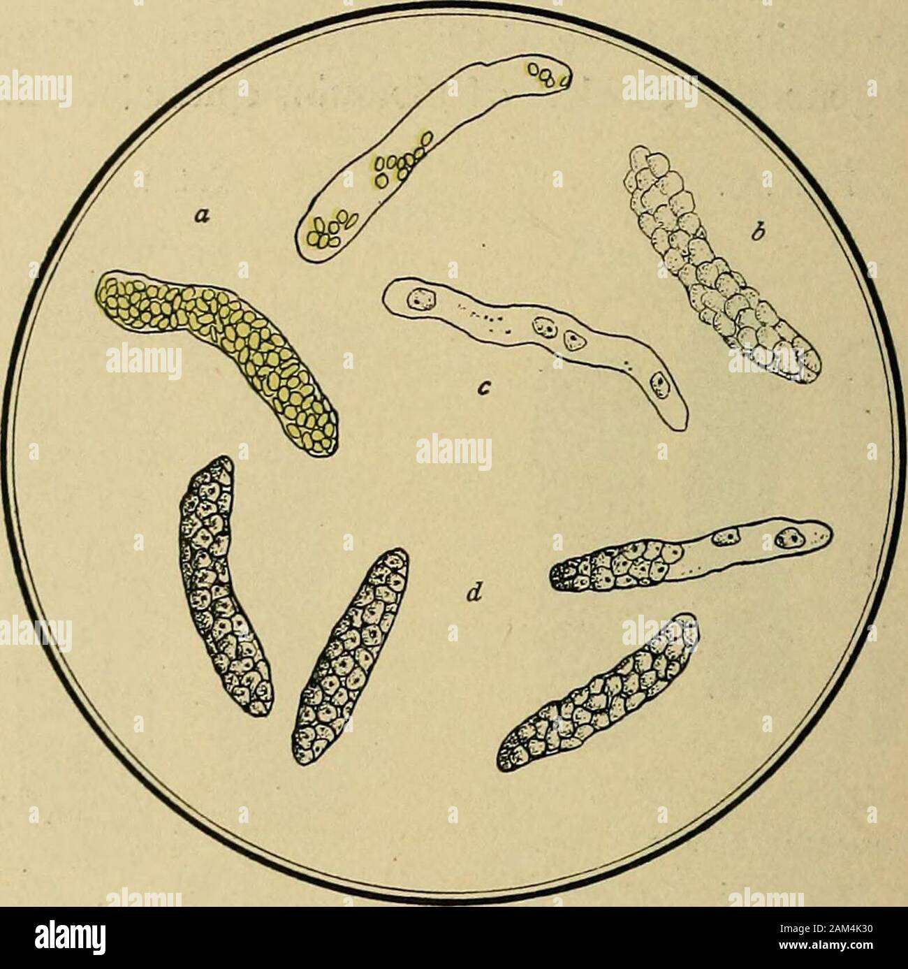 Granular Cast In Urine