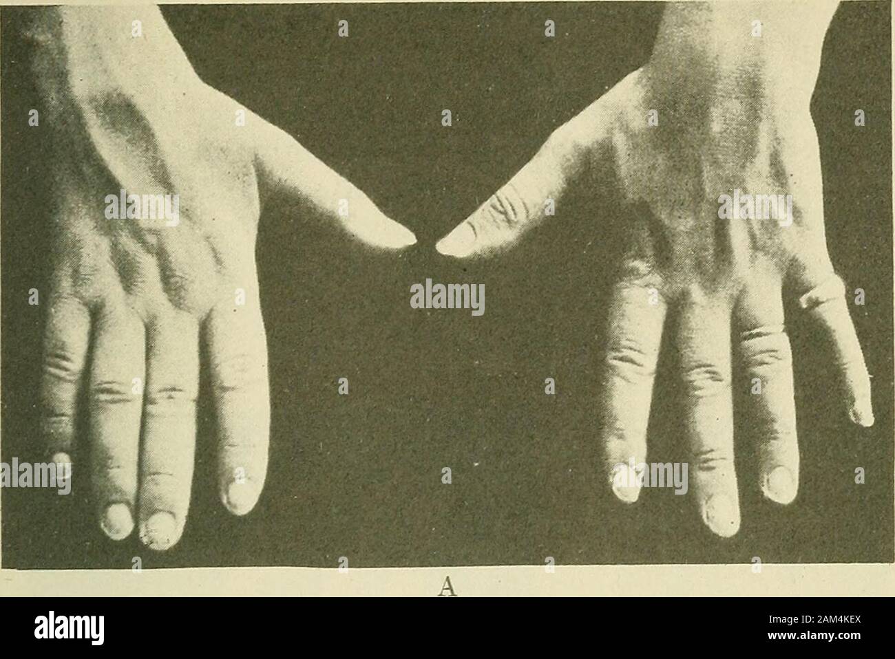 Medical and surgical therapy . the median and ubiar nerves on the ...