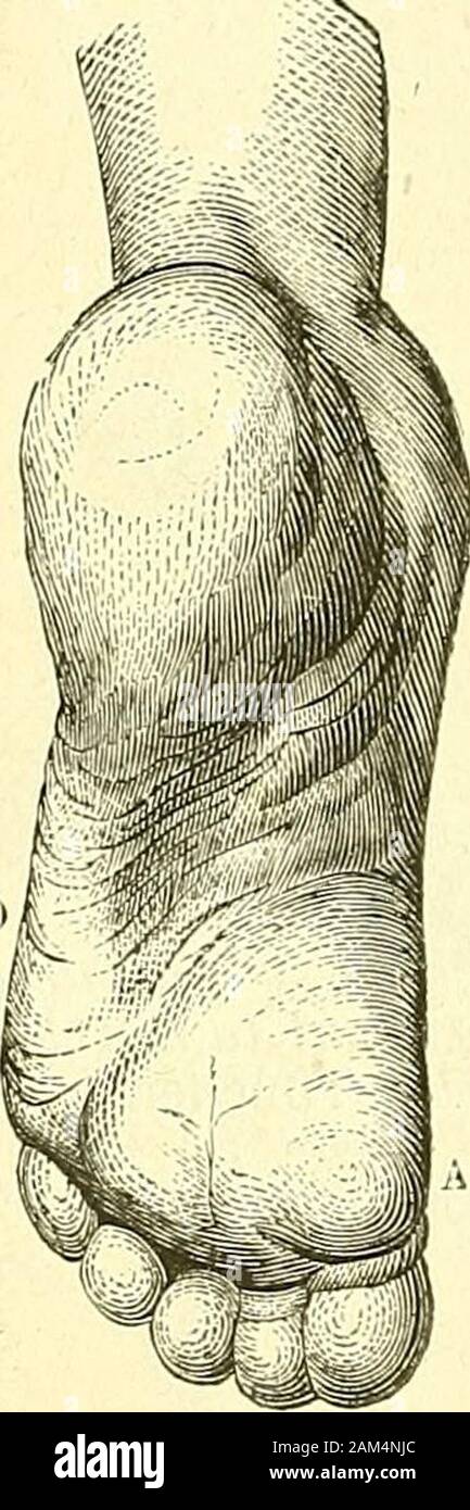 Muscle du pied hi-res stock photography and images - Alamy