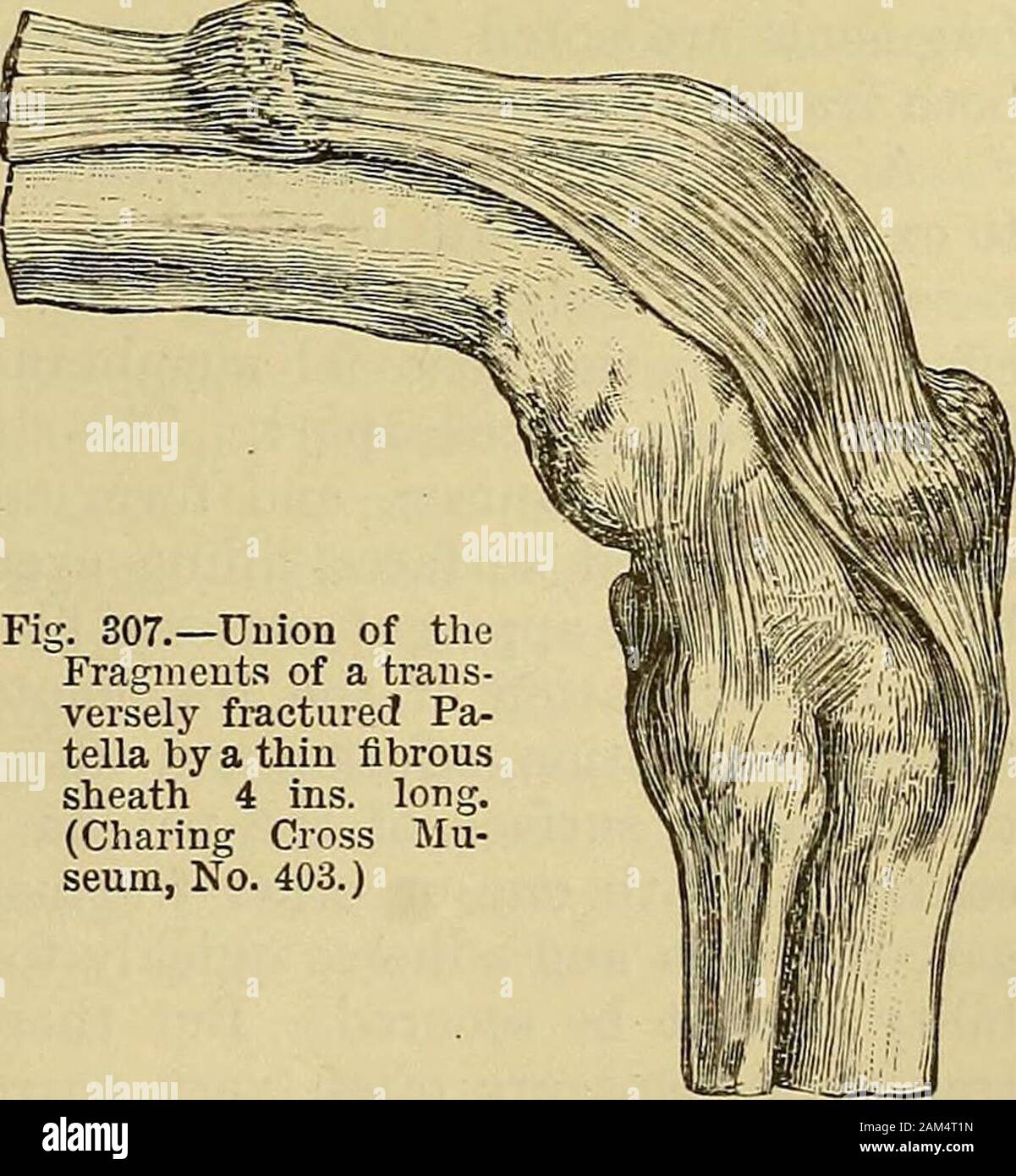 Compound bone fracture hi-res stock photography and images - Alamy
