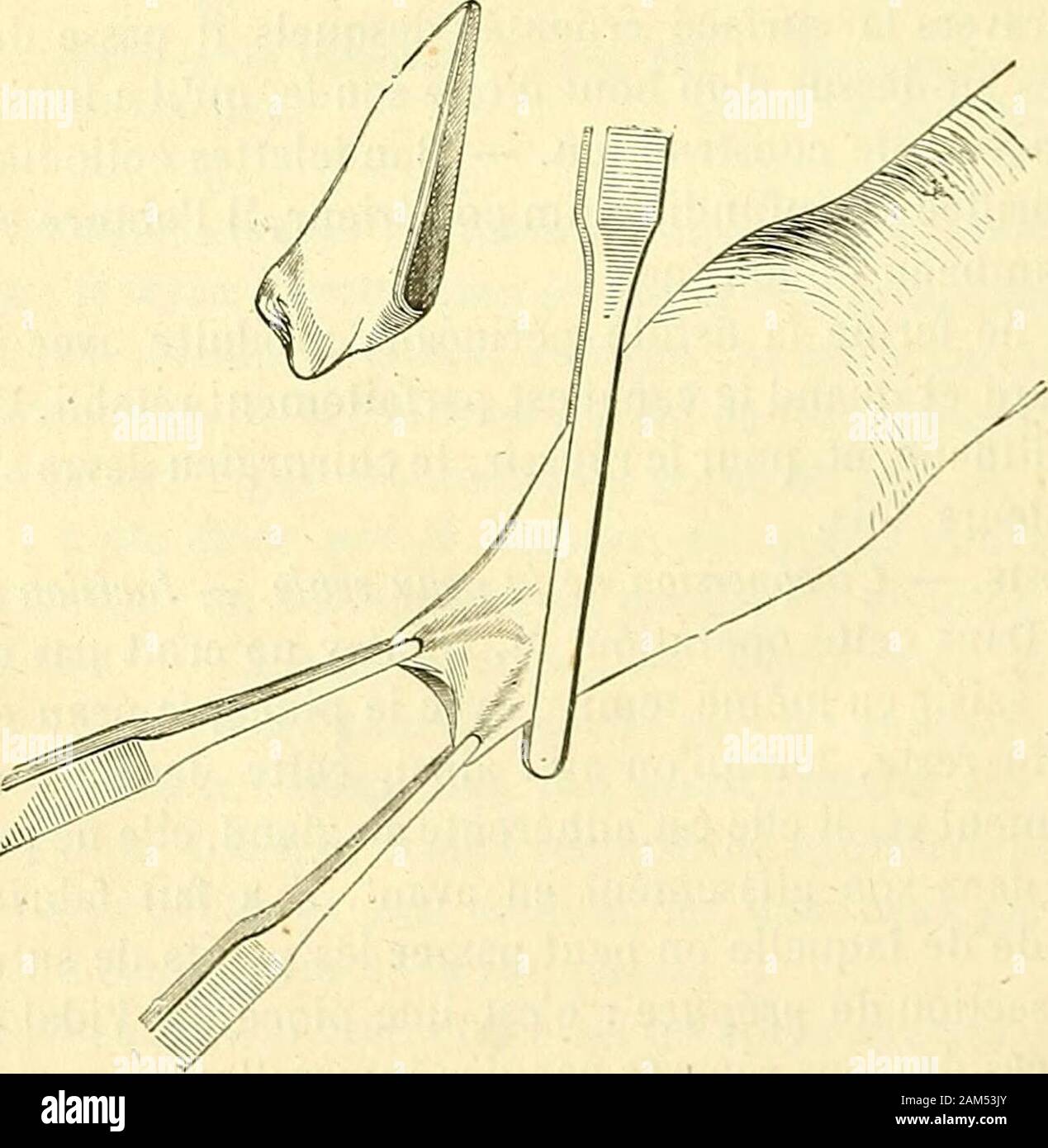 Phimosis hi-res stock photography and images - Alamy