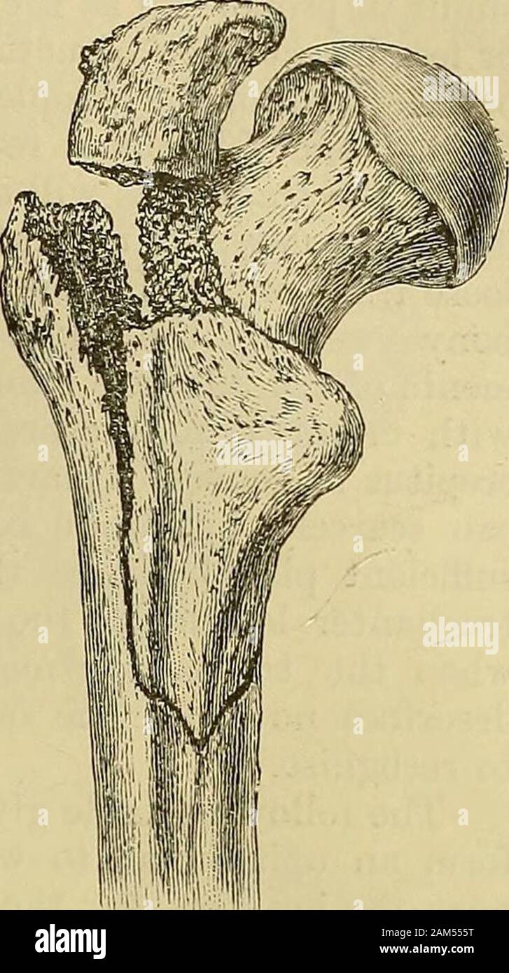 A system of surgery . it is FRACTURES OF THE FEMUR. 839 one of much ...
