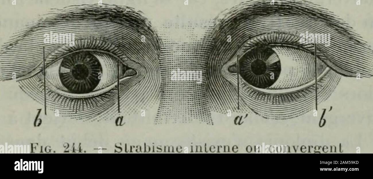 Chirurgie du strabisme hi-res stock photography and images - Alamy