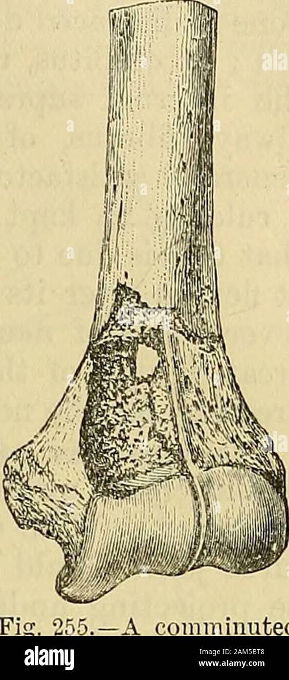 Capitellum hi-res stock photography and images - Alamy