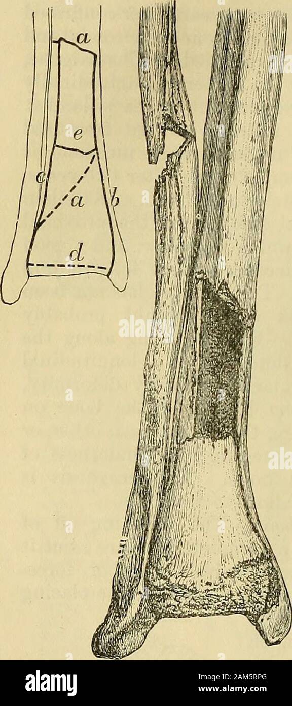 Fissures leg hi-res stock photography and images - Alamy
