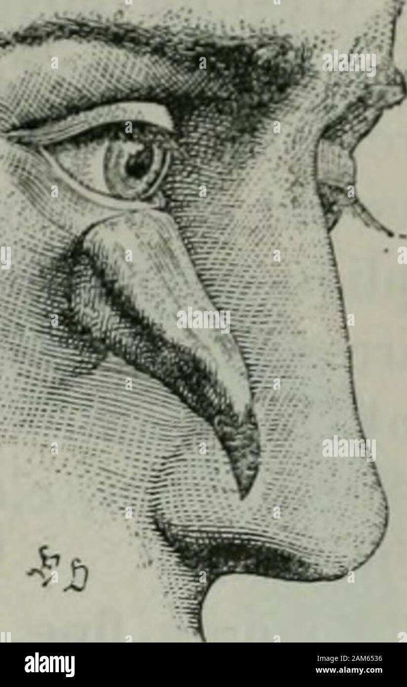 Kystes épidermique hi-res stock photography and images - Alamy