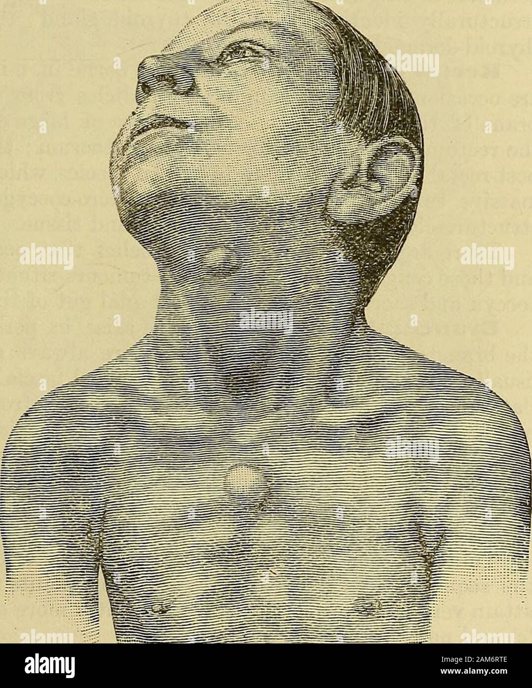 Sebaceous cysts hi-res stock photography and images - Alamy