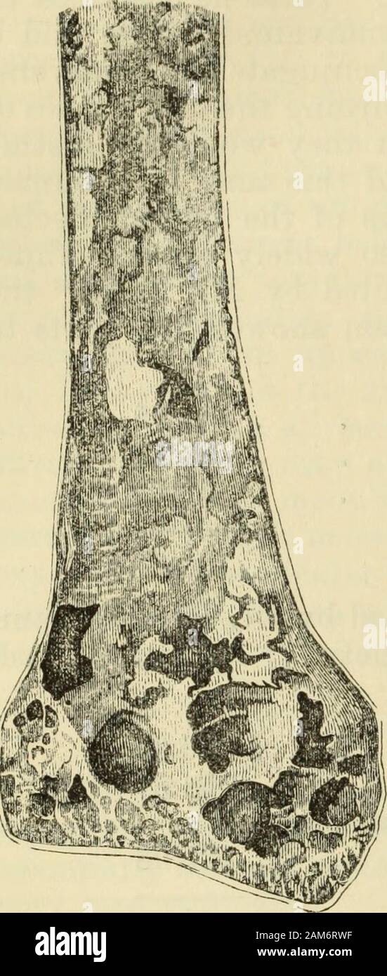 Medullary cavity hi-res stock photography and images - Alamy