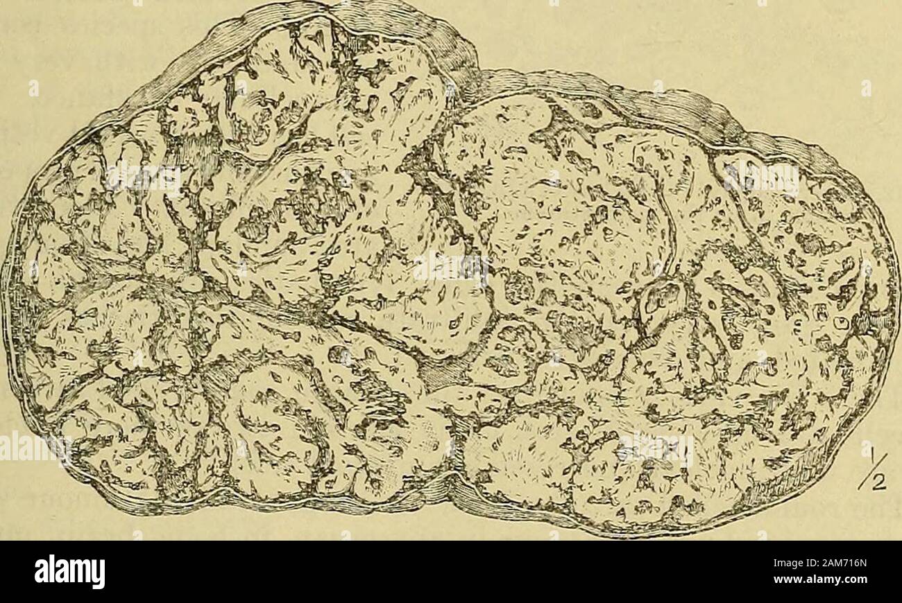 A system of surgery . Fig. 110.—Cavities, the result of Mucoid ...