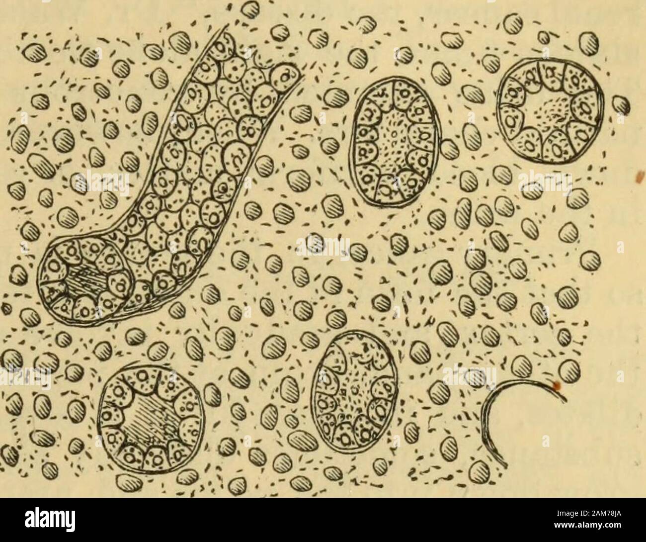 Lymphoid infiltration hi-res stock photography and images - Alamy