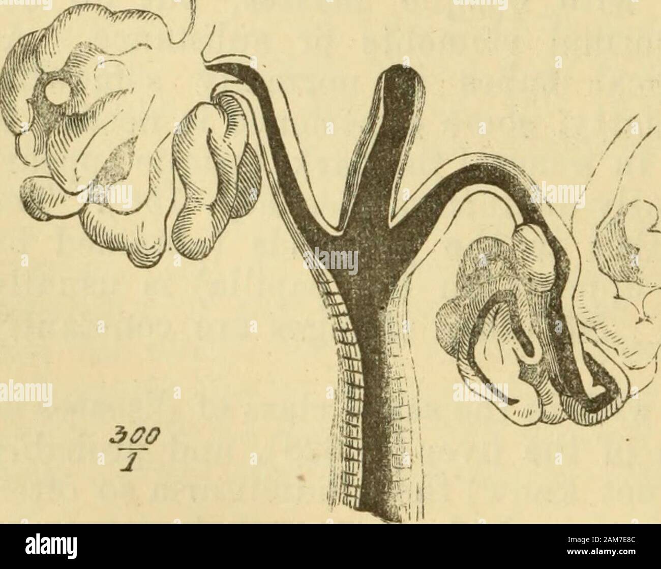 Pulmonary phthisis hi-res stock photography and images - Alamy