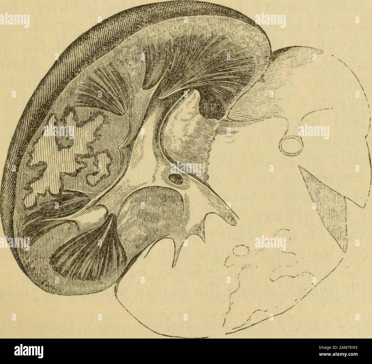 Induration hi-res stock photography and images - Alamy