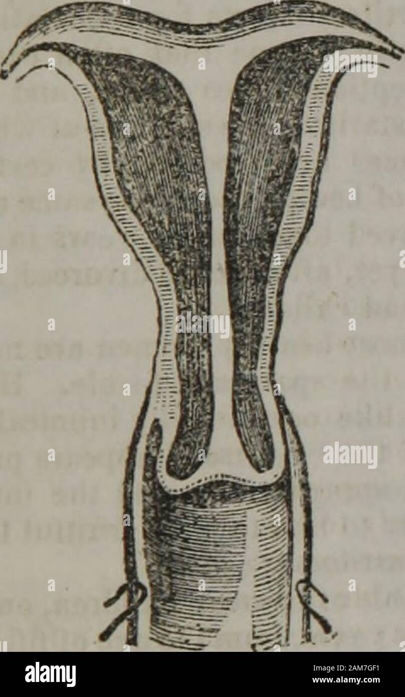 Double uterus hi-res stock photography and images - Alamy