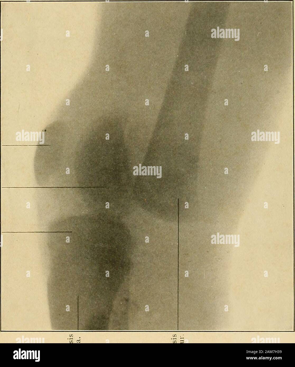 The treatment of fractures . shot wounds, 37Prognosis, 37 Subarachnoid ...