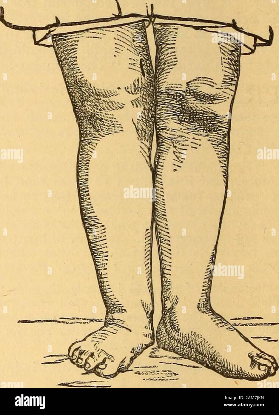 Outlines of the pathology and treatment of syphilis and allied venereal ...