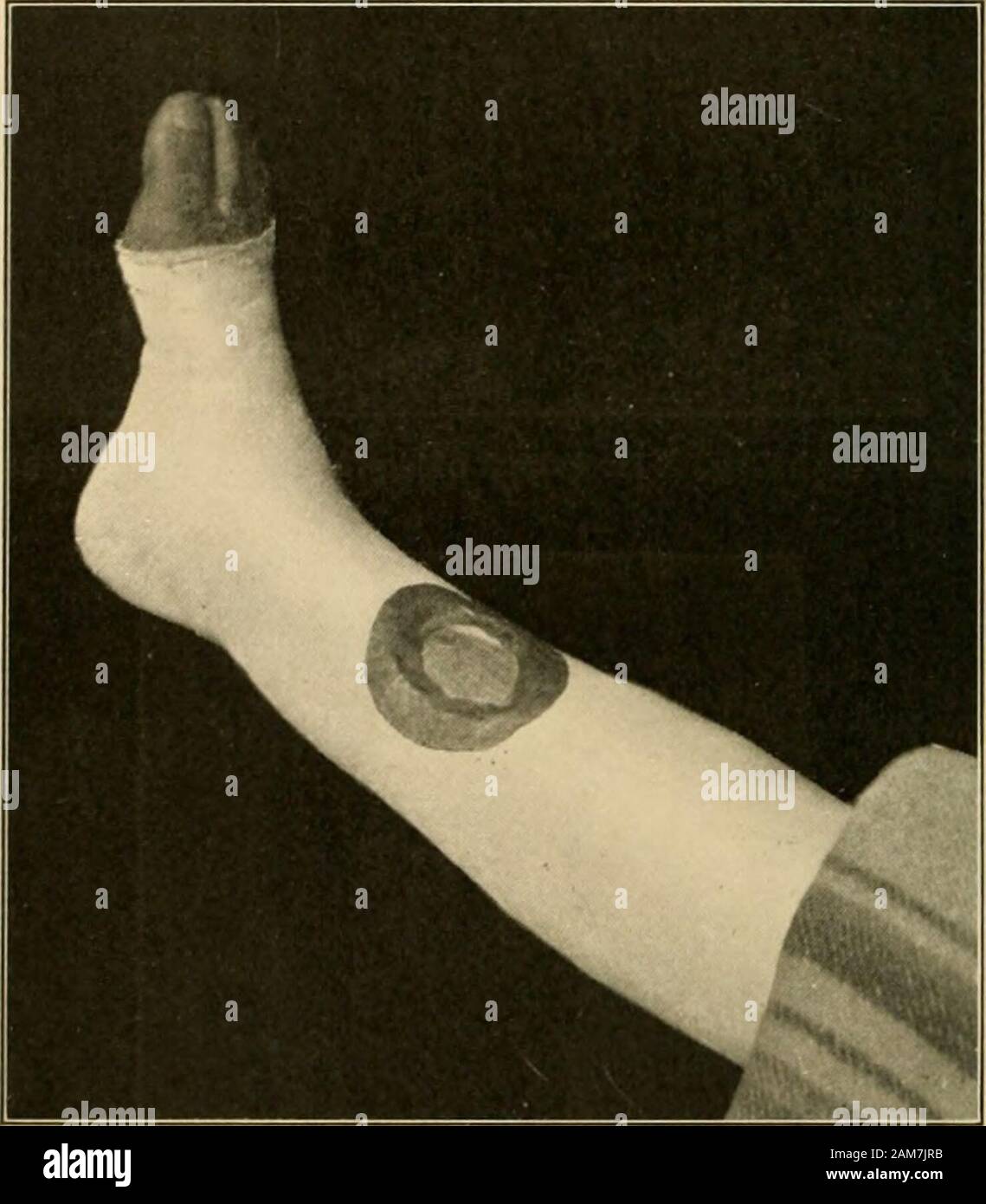 Fracture cast removable hi-res stock photography and images - Alamy