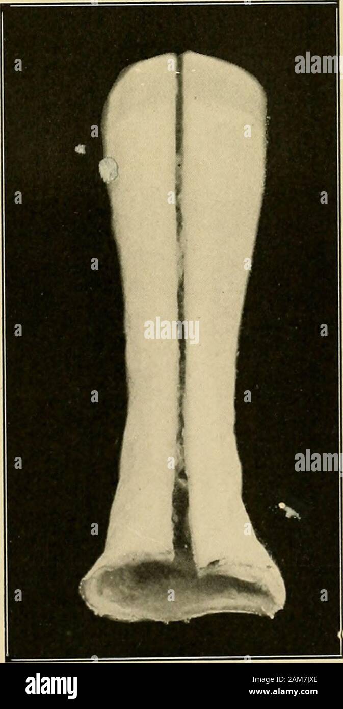 The treatment of fractures . Fig. 601.—Fracture of the leg. Plaster ...