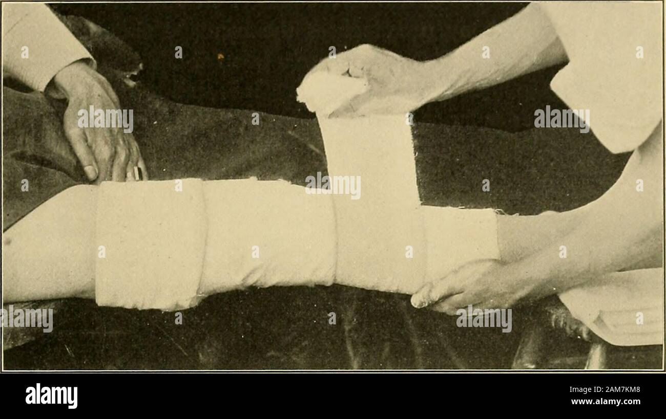 The treatment of fractures . Fig. 59.—Fracture of the elbow or forearm ...