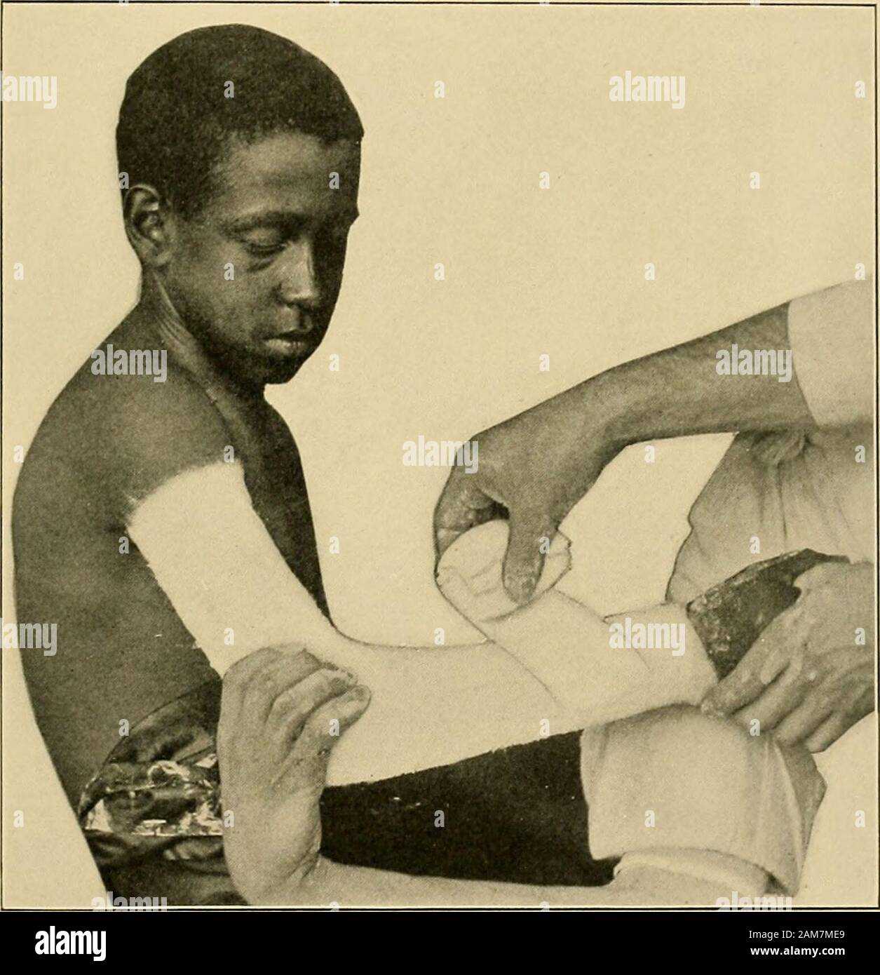 The treatment of fractures . Fig. 595- — Fracture of the elbow or ...