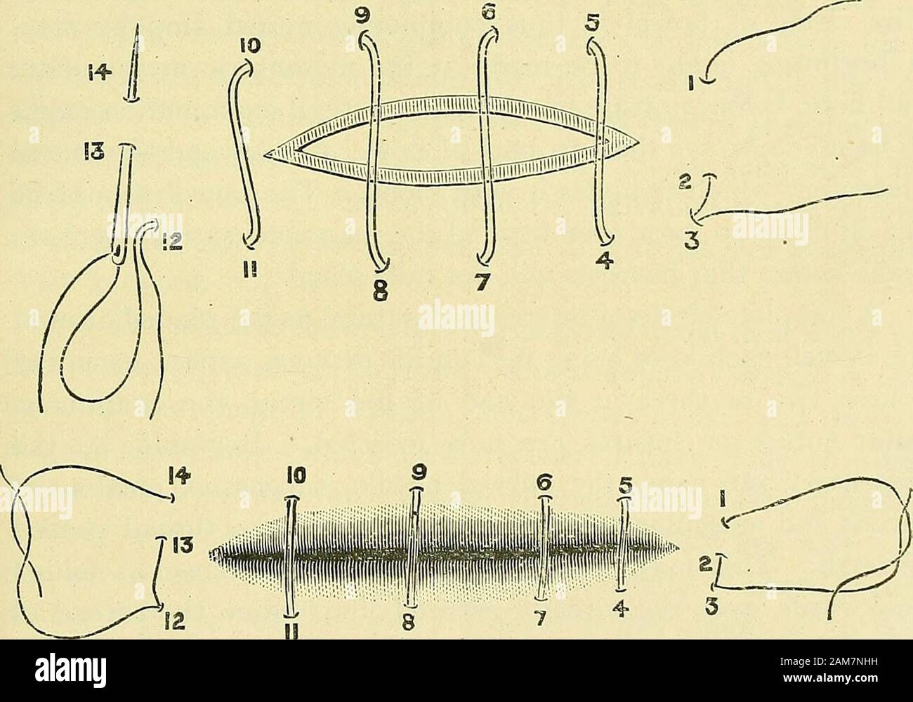 Abdominal surgery . Fig. 40. The Intestinal Sutnre of Appolito modified ...