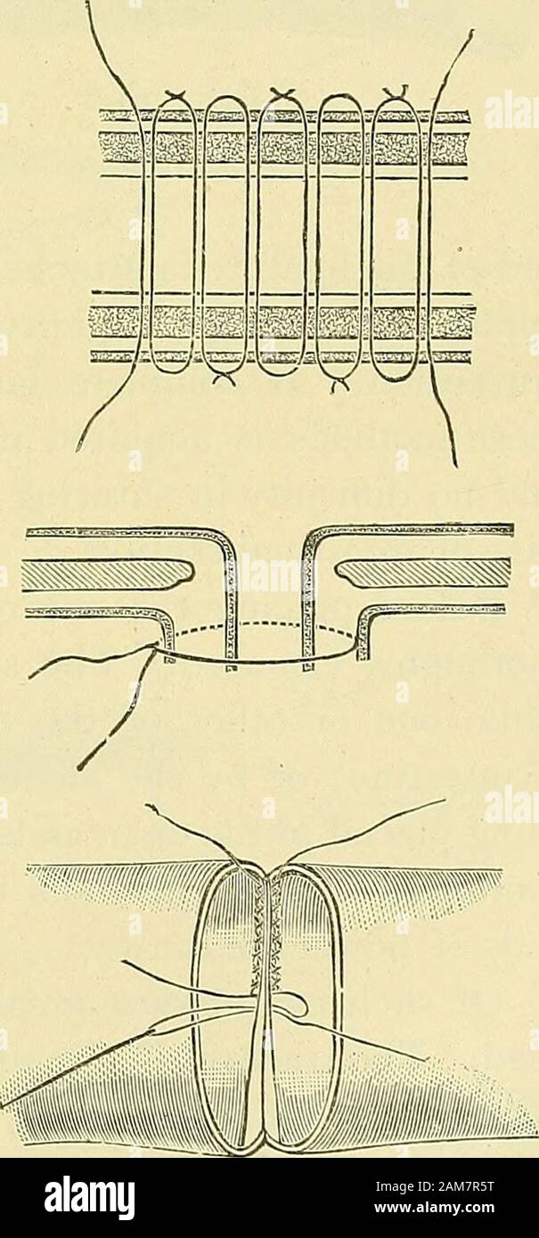 Abdominal surgery . ^ easy of application ; and it is open to the ...