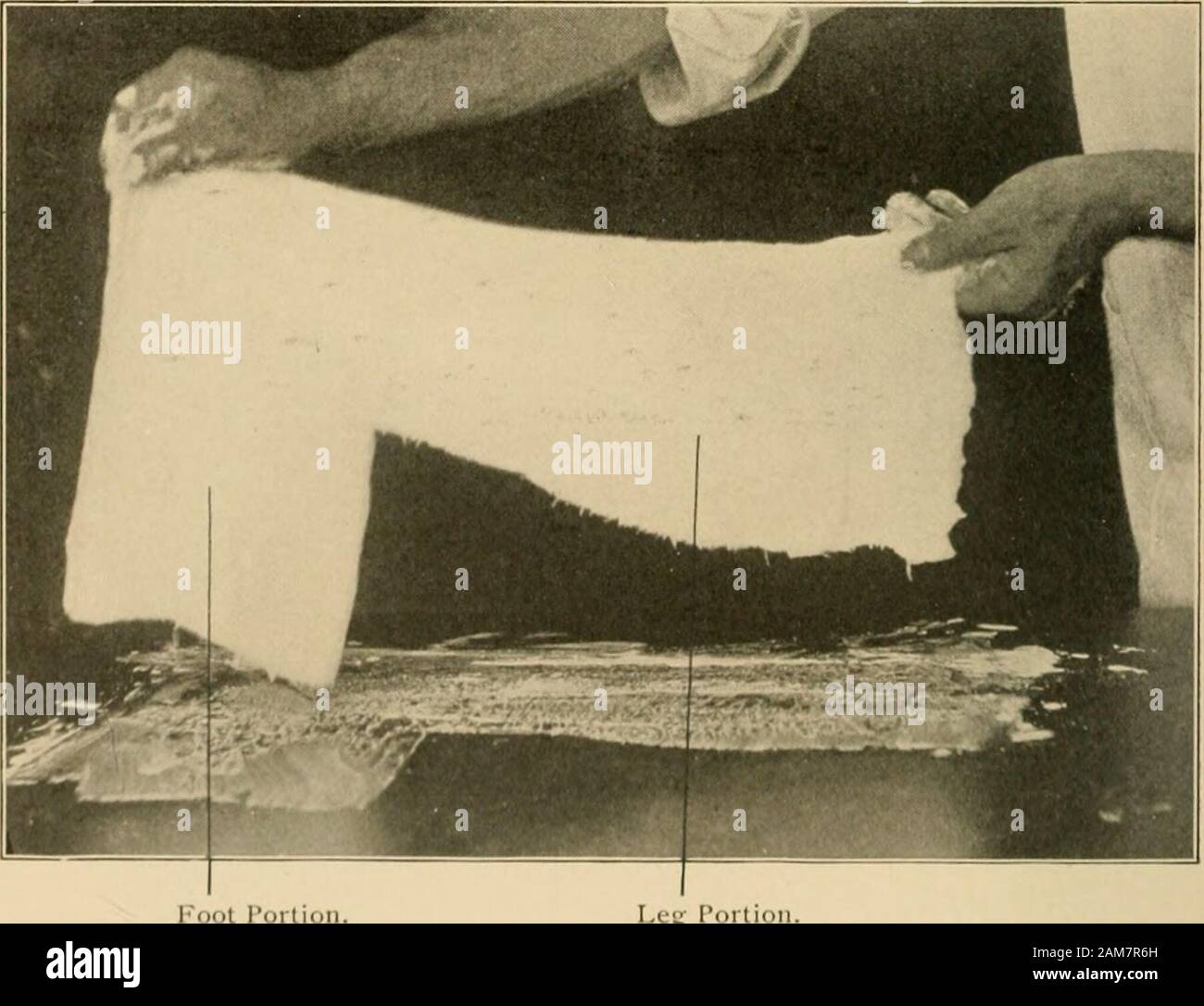 The treatment of fractures . Fig. 590.—Lateral or side splint of ...