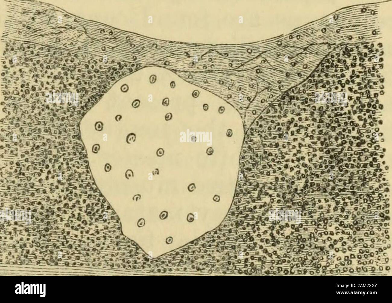 Submucous tissue hi-res stock photography and images - Alamy