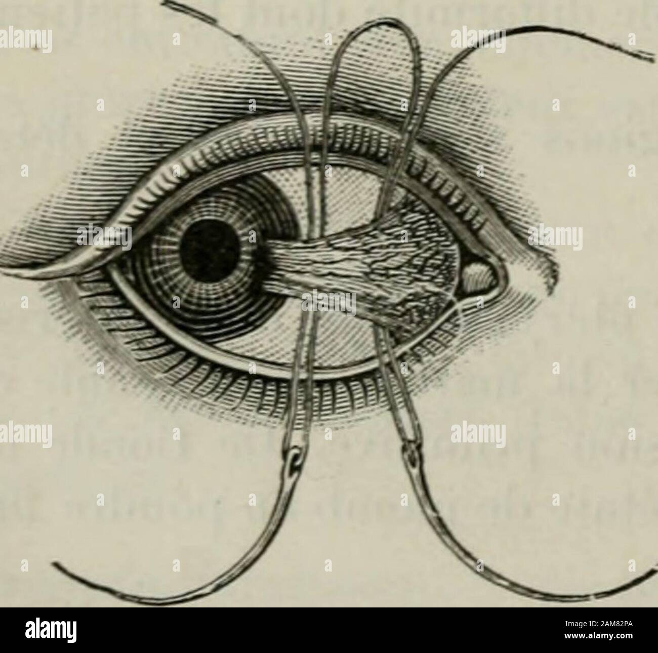 Plaie de suture hi-res stock photography and images - Alamy