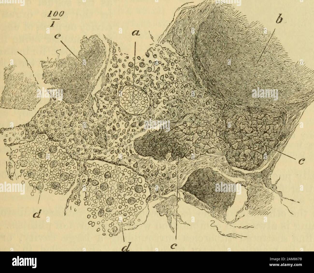 Induration hi-res stock photography and images - Alamy