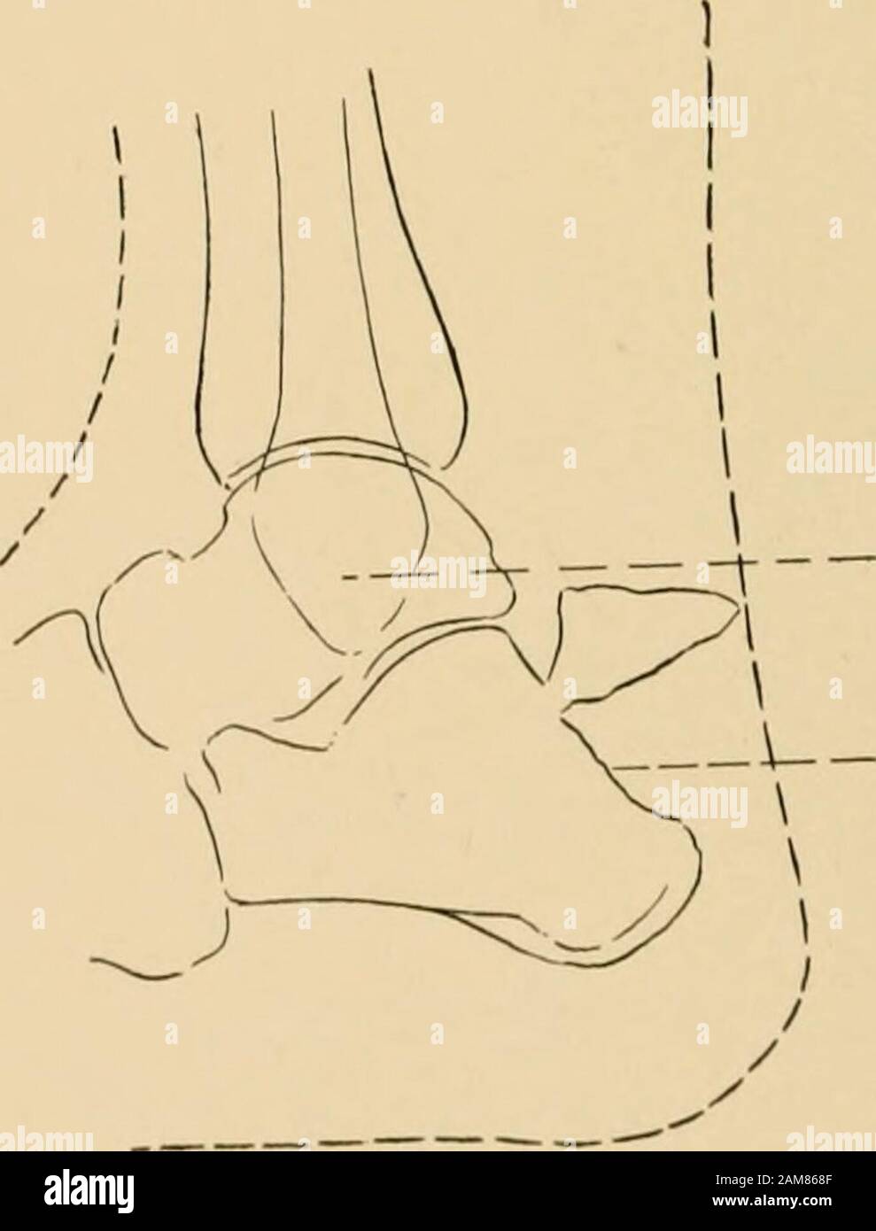 The treatment of fractures . Fig. 560.—Fracture of the left os calcis ...
