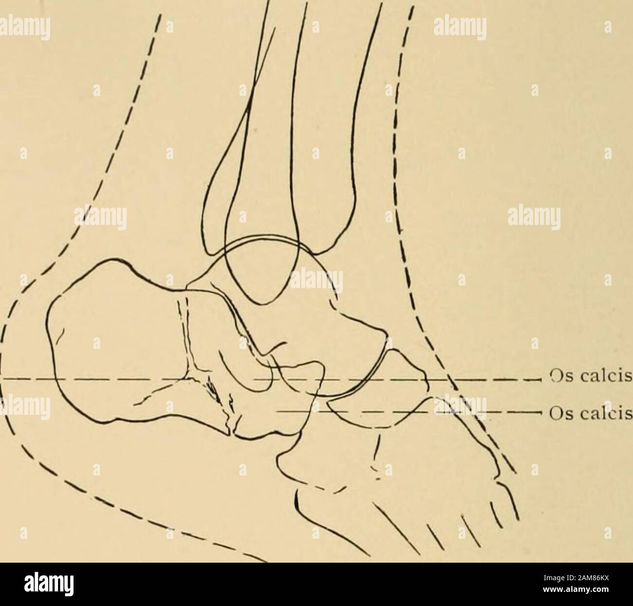 The treatment of fractures . Line of fracture. Fig. 559.—Fracture of ...