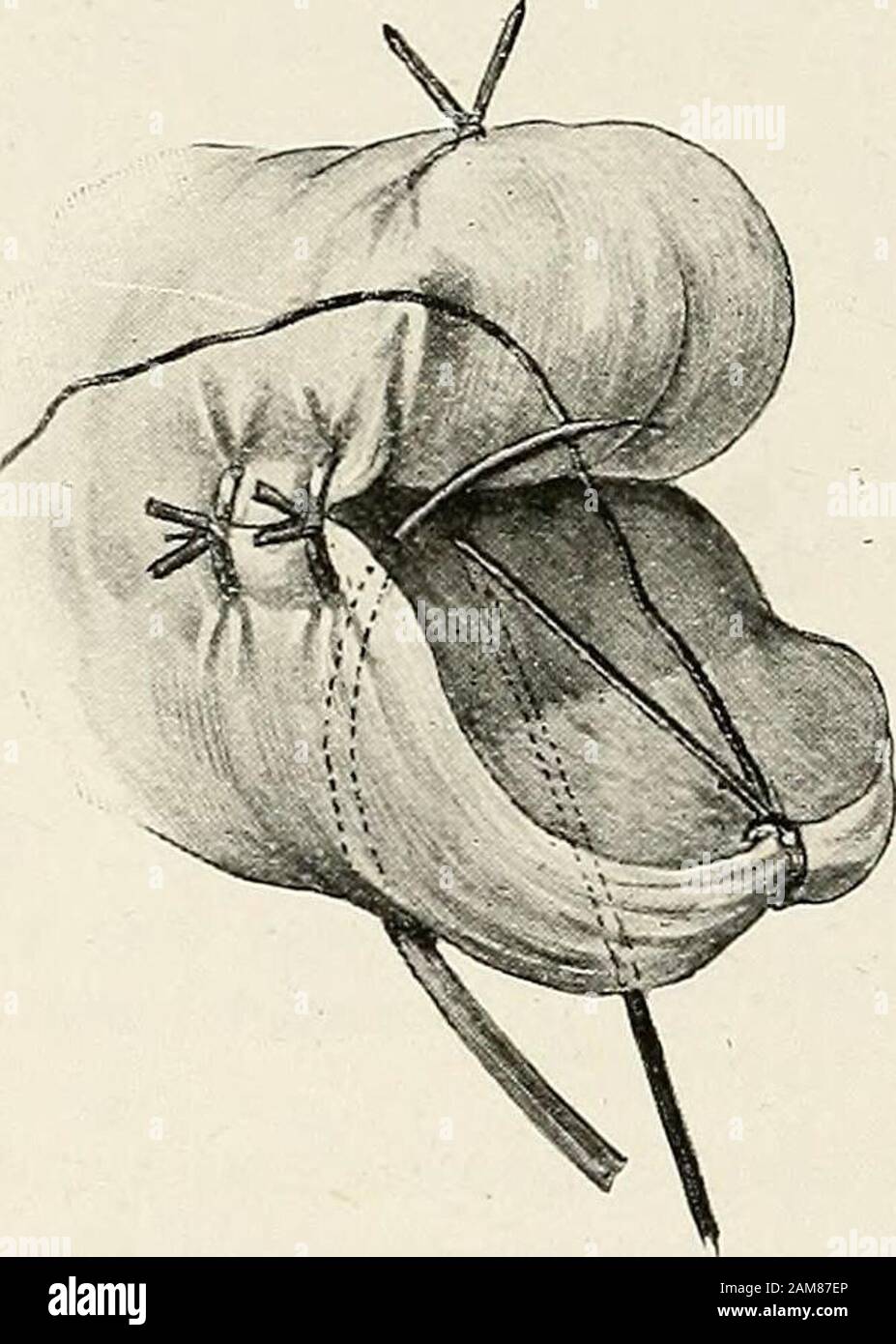 Gynaecology for students and practitioners . Fig. 473. Trachelorrhaphy ...
