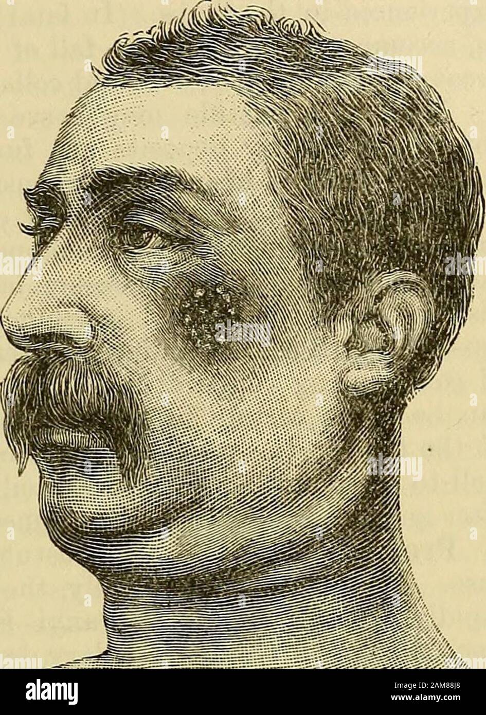 A system of surgery . nner till the carbuncle reaches a considerable ...