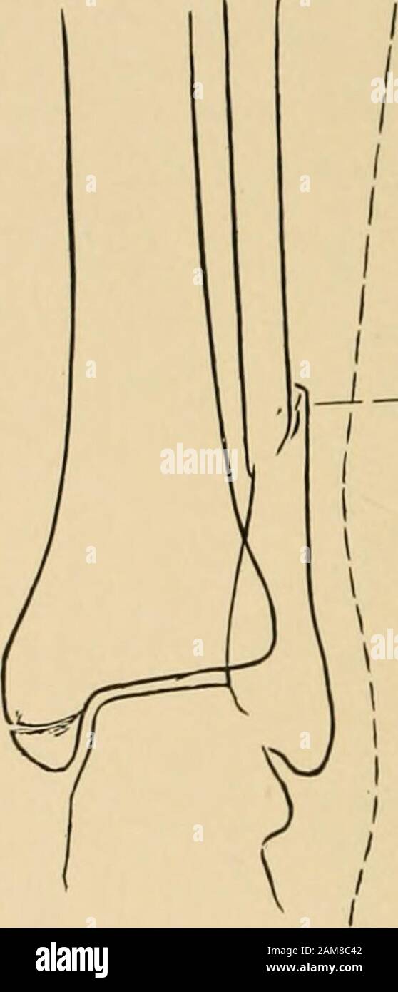 Lateral muscles of lower leg hi-res stock photography and images - Alamy