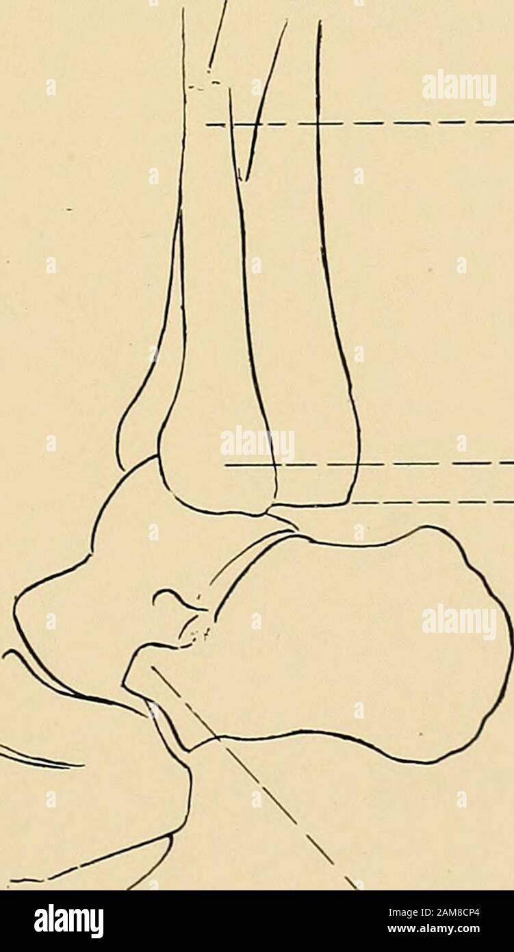 The treatment of fractures . Astragalus. / Tibia. Internal malleolus ...