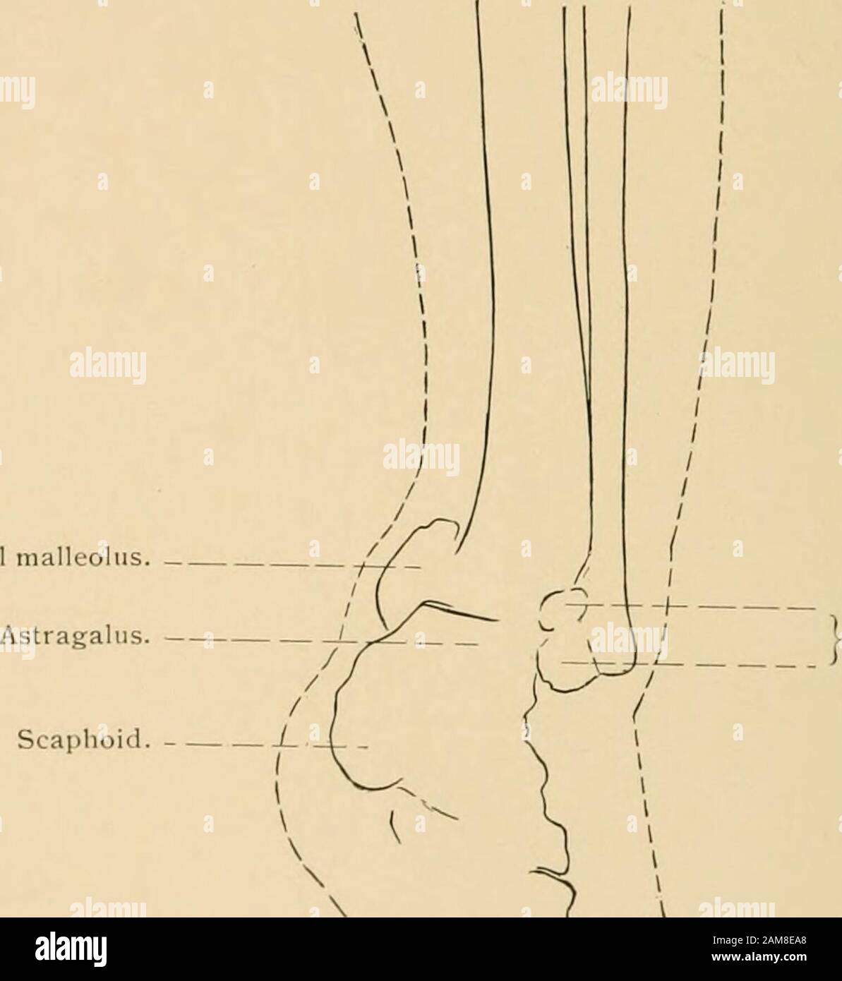 The treatment of fractures . y tracing, Fig- 537)- POTTS ...