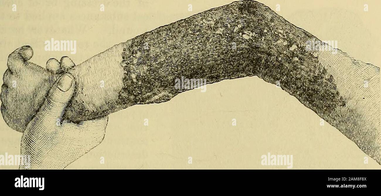 A system of surgery . this lymph which glues together the cutsurfaces ...